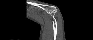 CT Ellenbogen | Praxis für Radiologische Diagnostik Hanau