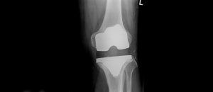 Röntgen Knie | Praxis für Radiologische Diagnostik Hanau