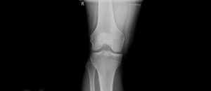 Röntgen Knie | Praxis für Radiologische Diagnostik Hanau